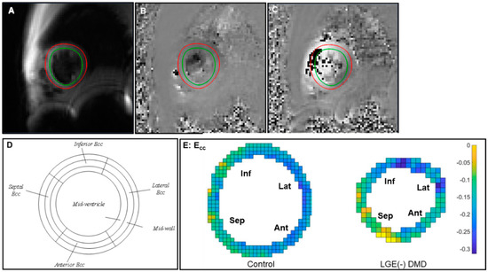 MRI-Based Circumferential Strain in Boys with Early Duchenne Muscular ...