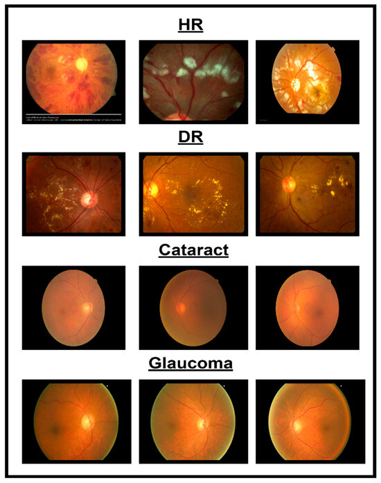 CAD-EYE: An Automated System for Multi-Eye Disease Classification Using ...