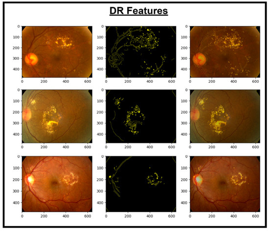CAD-EYE: An Automated System for Multi-Eye Disease Classification Using ...