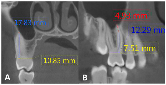 An Evaluation of the Relationship Between the Mesiobuccal Canal ...
