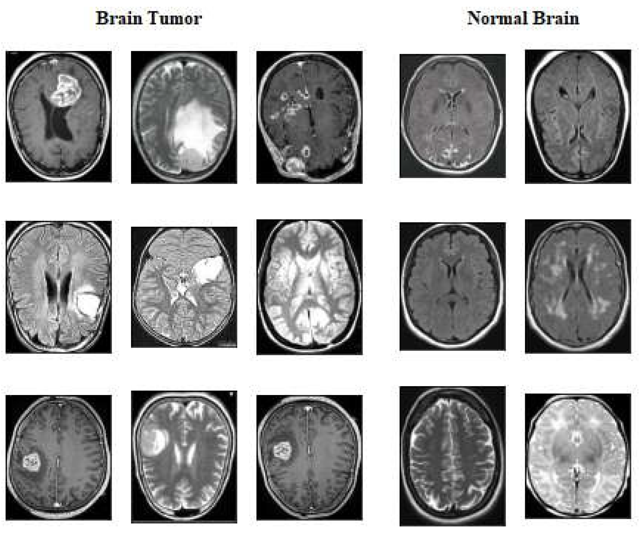 A Hybrid Deep Learning Model with Data Augmentation to Improve Tumor ...