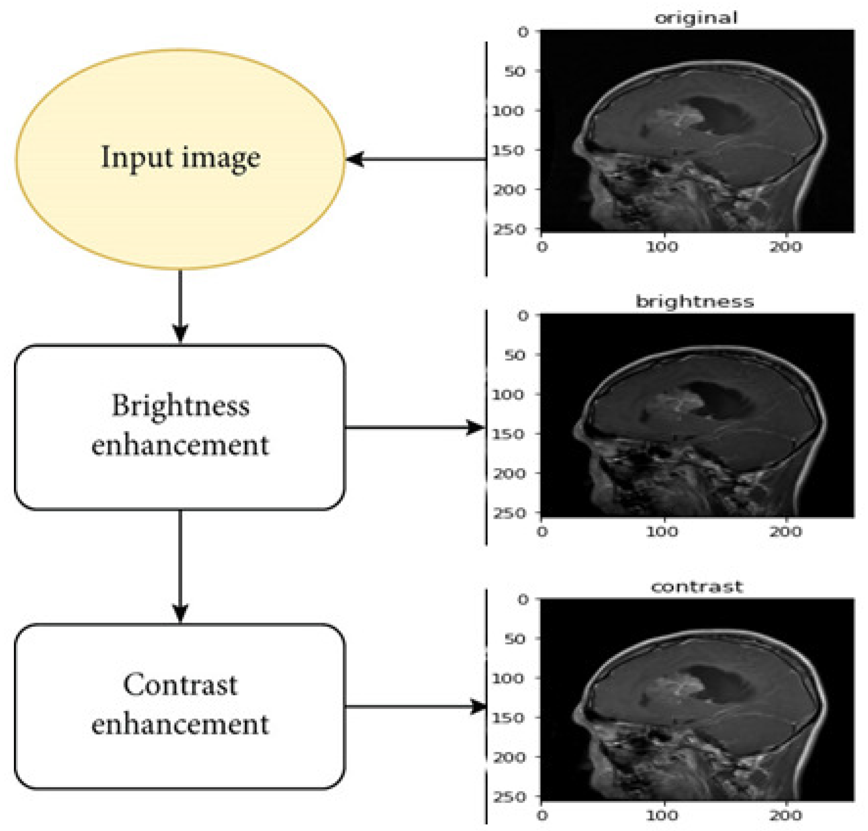 A Hybrid Deep Learning Model with Data Augmentation to Improve Tumor Classification Using MRI Images