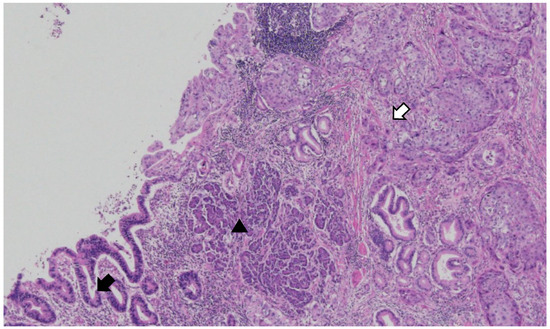 Mixed Pancreatobiliary Ductal Adenocarcinoma and Squamous Cell Carcinoma Arising from an Ectopic ...