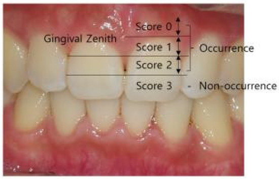 The Occurrence and Risk Factors of Black Triangles Between Central ...