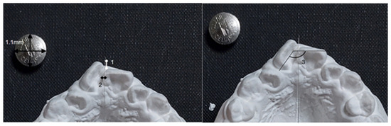 The Occurrence and Risk Factors of Black Triangles Between Central ...