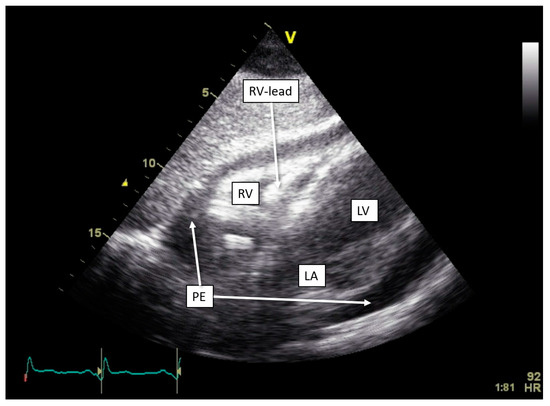 Daily Measurements from Cardiac Implantable Electronic Devices to ...