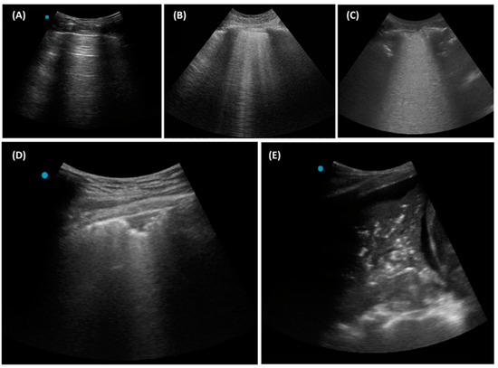 Ten Questions on Using Lung Ultrasonography to Diagnose and Manage ...