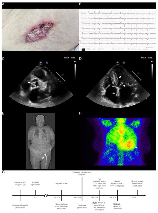 Multiple Red Flags of Cardiac Amyloidosis in a Single Patient: Clinical ...
