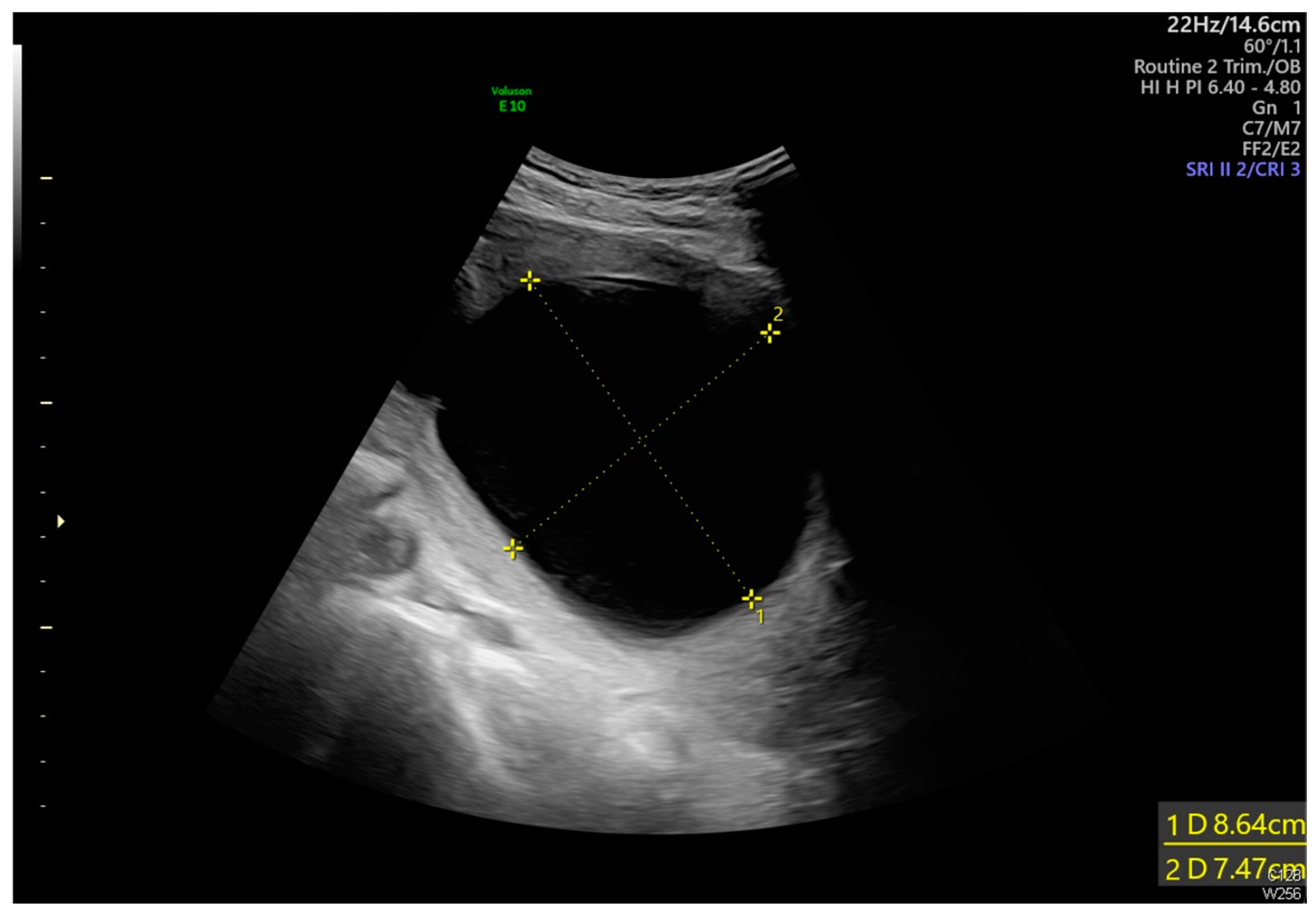 Intrauterine Adhesion-Induced Septated Amniotic Cavity ...