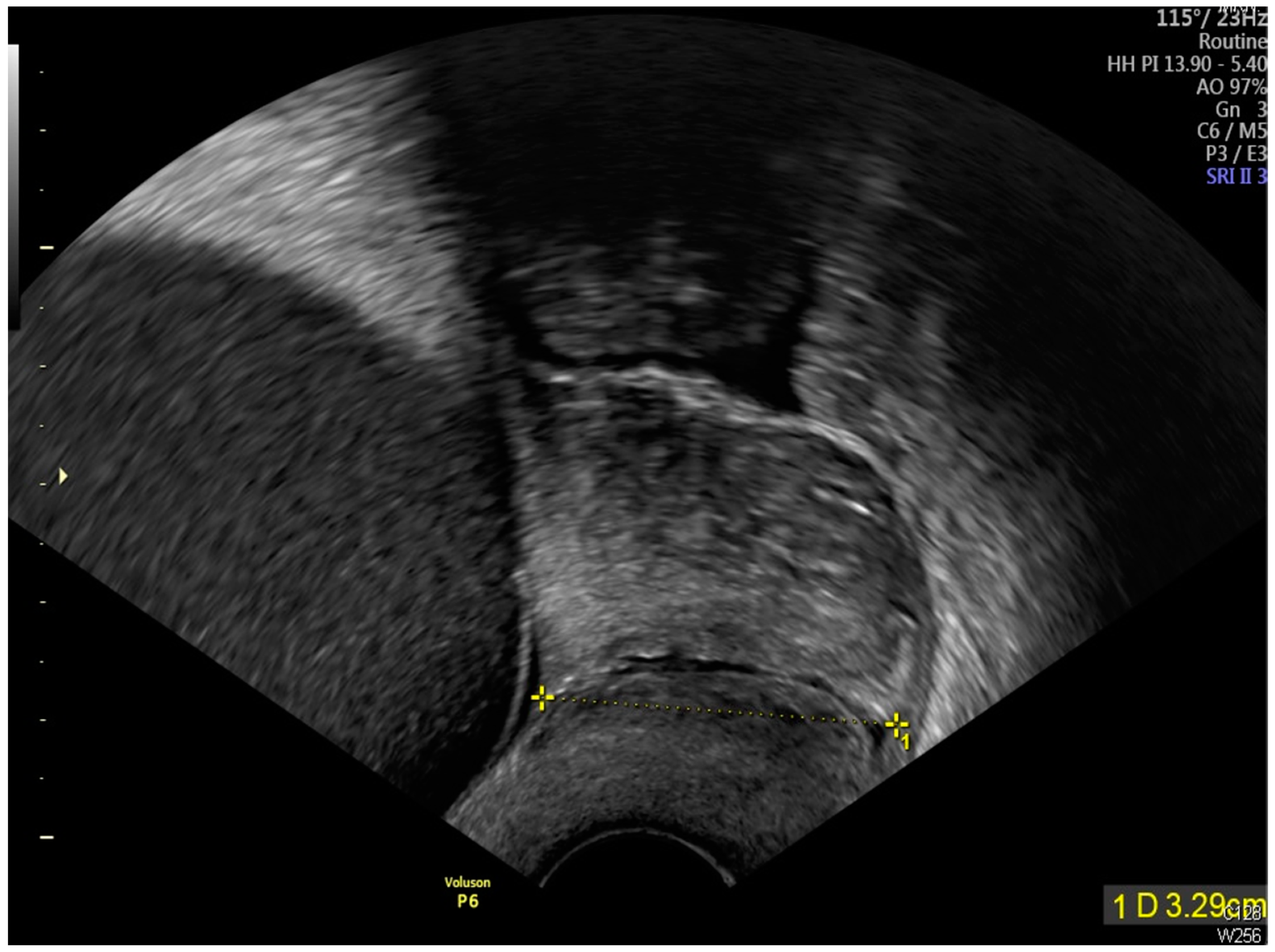 Intrauterine Adhesion-Induced Septated Amniotic Cavity ...