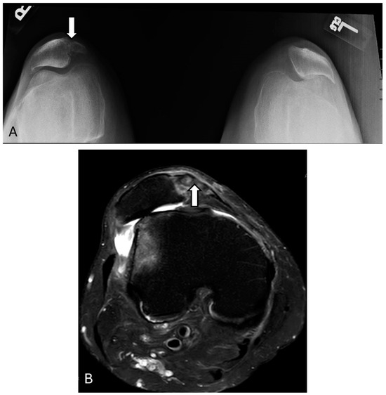 Patellar Non-Traumatic Pathologies: A Pictorial Review of Radiologic ...