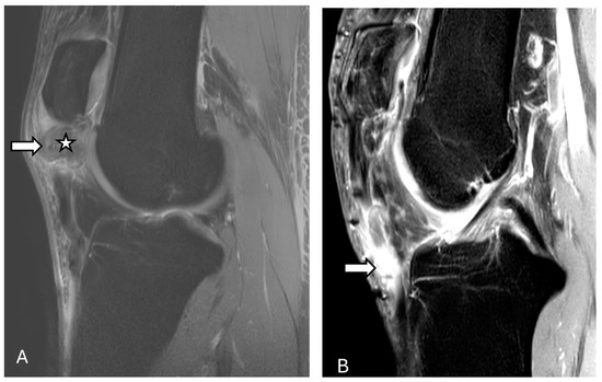 Patellar Non-Traumatic Pathologies: A Pictorial Review of Radiologic ...