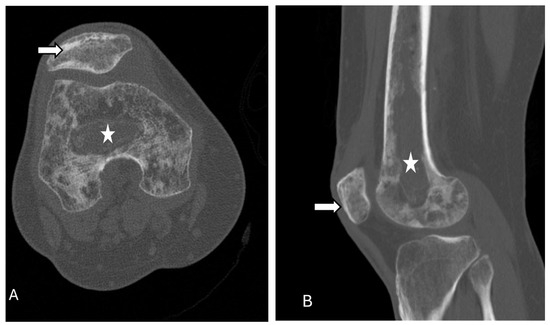 Patellar Non-Traumatic Pathologies: A Pictorial Review of Radiologic ...