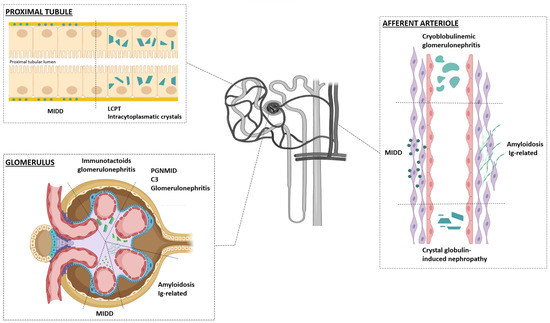 Diagnostic and Therapeutic Aspects of Monoclonal Gammopathies of Renal ...