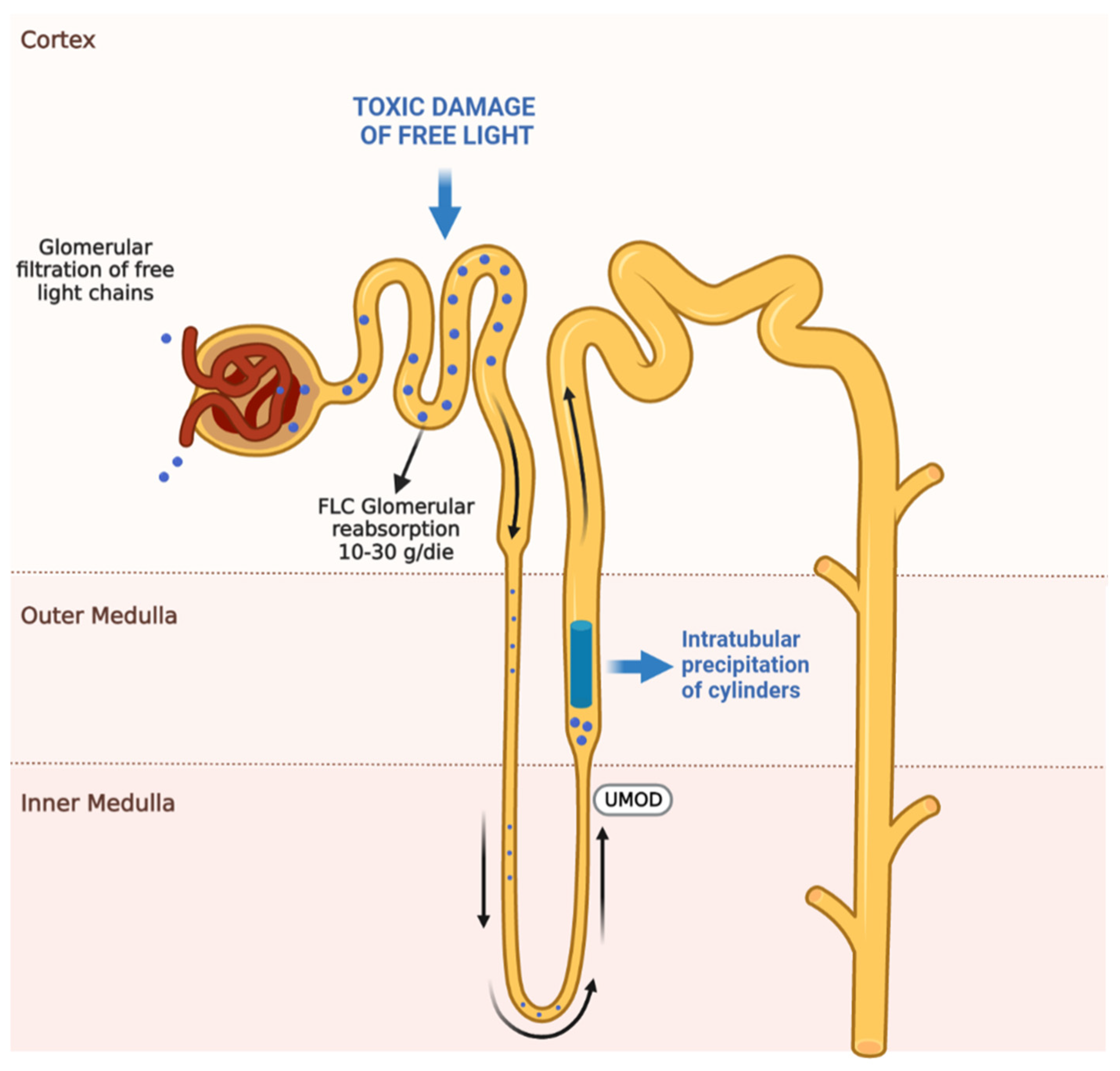Diagnostic and Therapeutic Aspects of Monoclonal Gammopathies of Renal ...