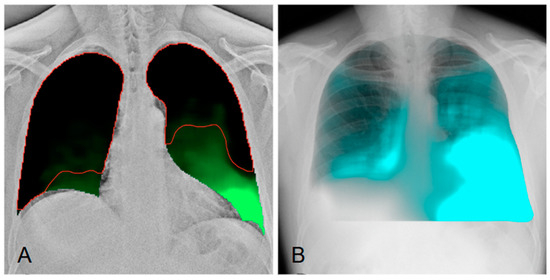 Dynamic Digital Radiography (DDR) in the Diagnosis of a Diaphragm ...