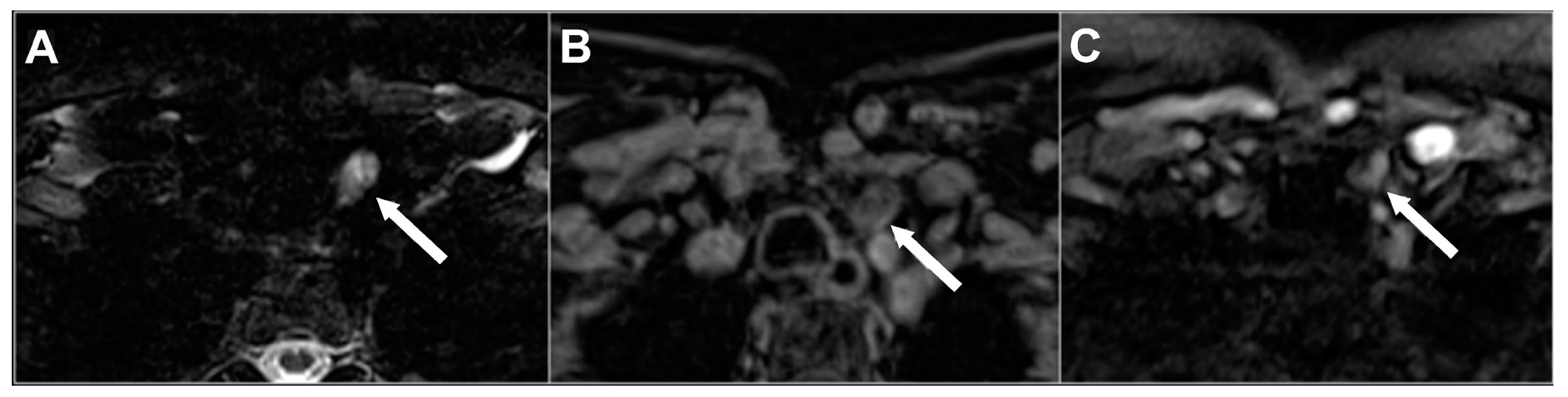 Up-to-Date Imaging for Parathyroid Tumor Localization in MEN1 Patients ...