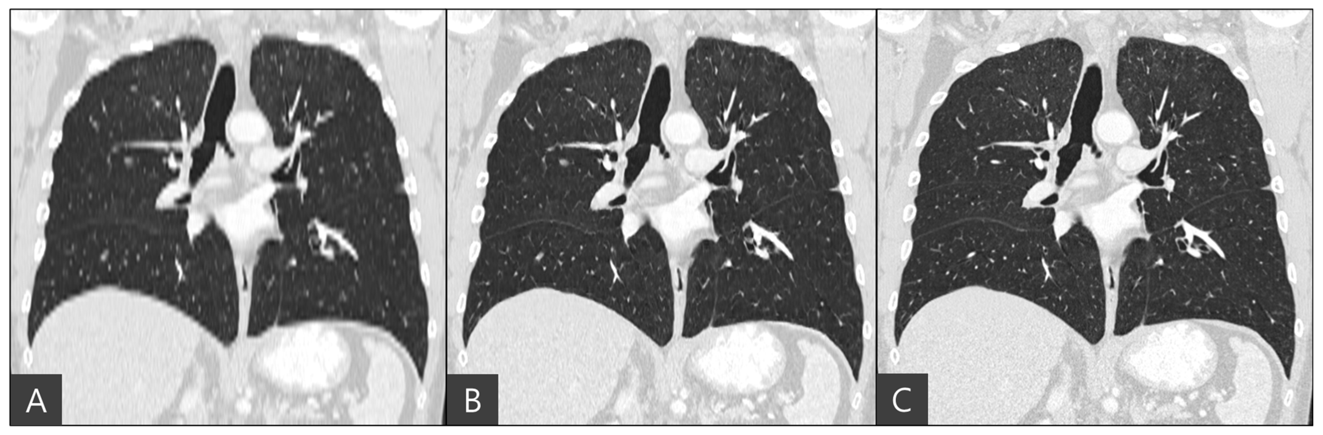 Improved Consistency of Lung Nodule Categorization in CT Scans with Heterogeneous Slice ...