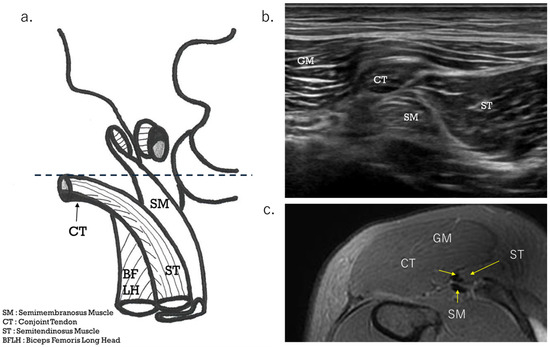 Ultrasound Diagnosis of Hamstring Muscle Complex Injuries Focus on ...
