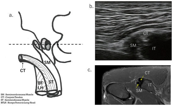 Ultrasound Diagnosis of Hamstring Muscle Complex Injuries Focus on ...