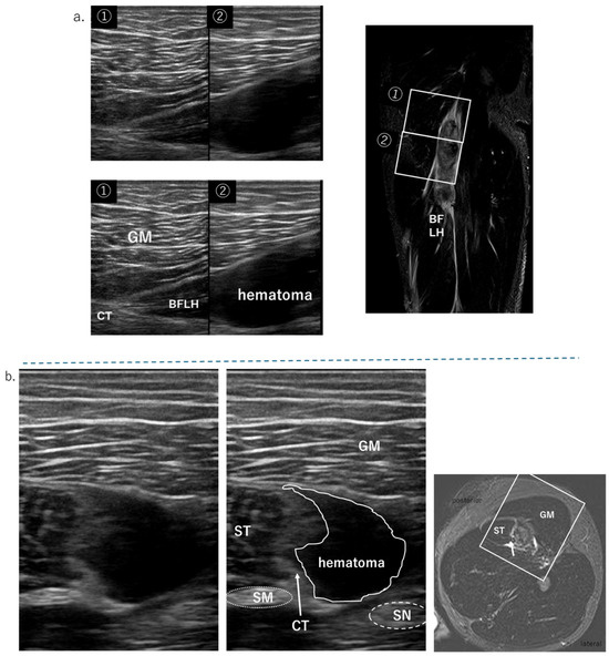 Ultrasound Diagnosis of Hamstring Muscle Complex Injuries Focus on ...