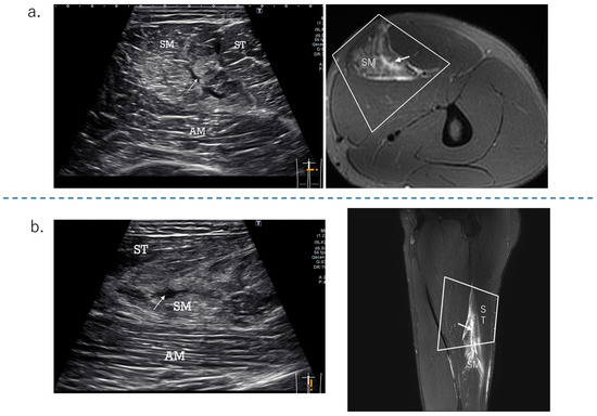 Ultrasound Diagnosis of Hamstring Muscle Complex Injuries Focus on ...