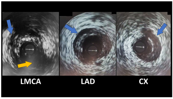 Spontaneous Coronary Artery Dissection Involving the Left Main with ...