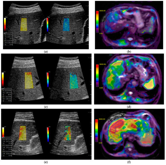 Two-Dimensional Shear-Wave Elastography: Accuracy in Liver Fibrosis ...