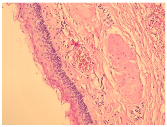 Tailgut Cyst—Gynecologist’s Pitfall: Literature Review and Case Report