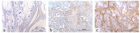 Impact of HIF-1α, LOX and ITGA5 Synergistic Interaction in the Tumor ...