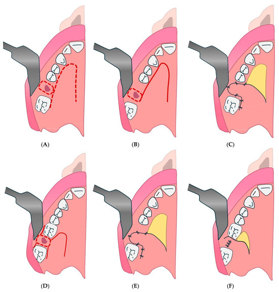 Management of Oro-Antral Communication: A Systemic Review of Diagnostic ...