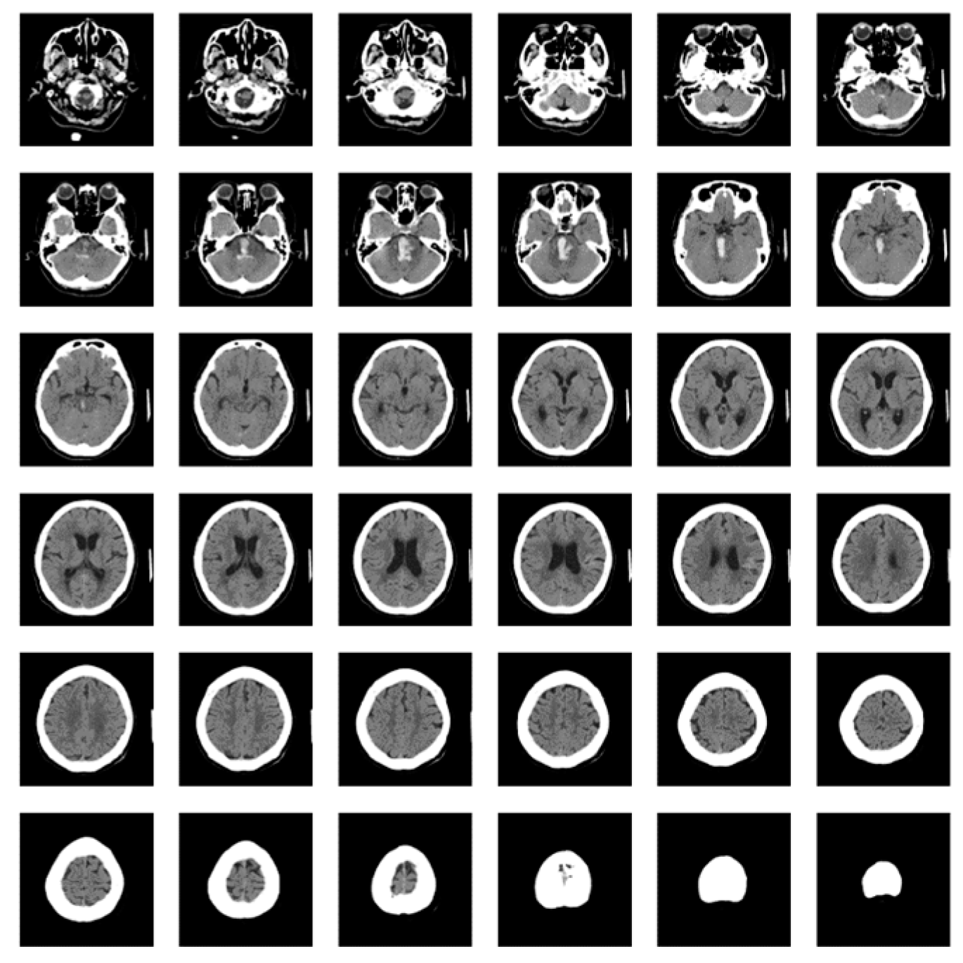 Impact of Dataset Size on 3D CNN Performance in Intracranial Hemorrhage ...