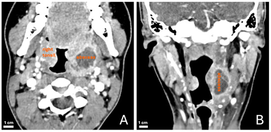Diagnosis of Peritonsillar Abscess—A Prospective Study Comparing ...