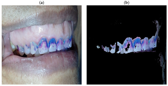 Deep Learning in Oral Hygiene: Automated Dental Plaque Detection via ...