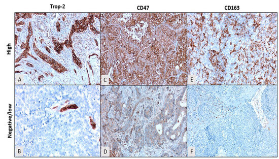 Exploring the Prognostic Role of Trop-2, CD47, and CD163 Expression ...