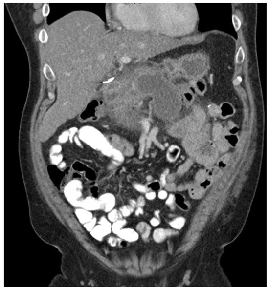 Diagnosis and Management of Acute Pancreatitis