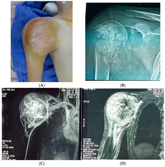 Clinical and Pathological Profile of Children and Adolescents with Osteosarcoma