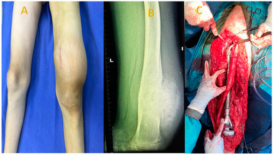Clinical and Pathological Profile of Children and Adolescents with Osteosarcoma