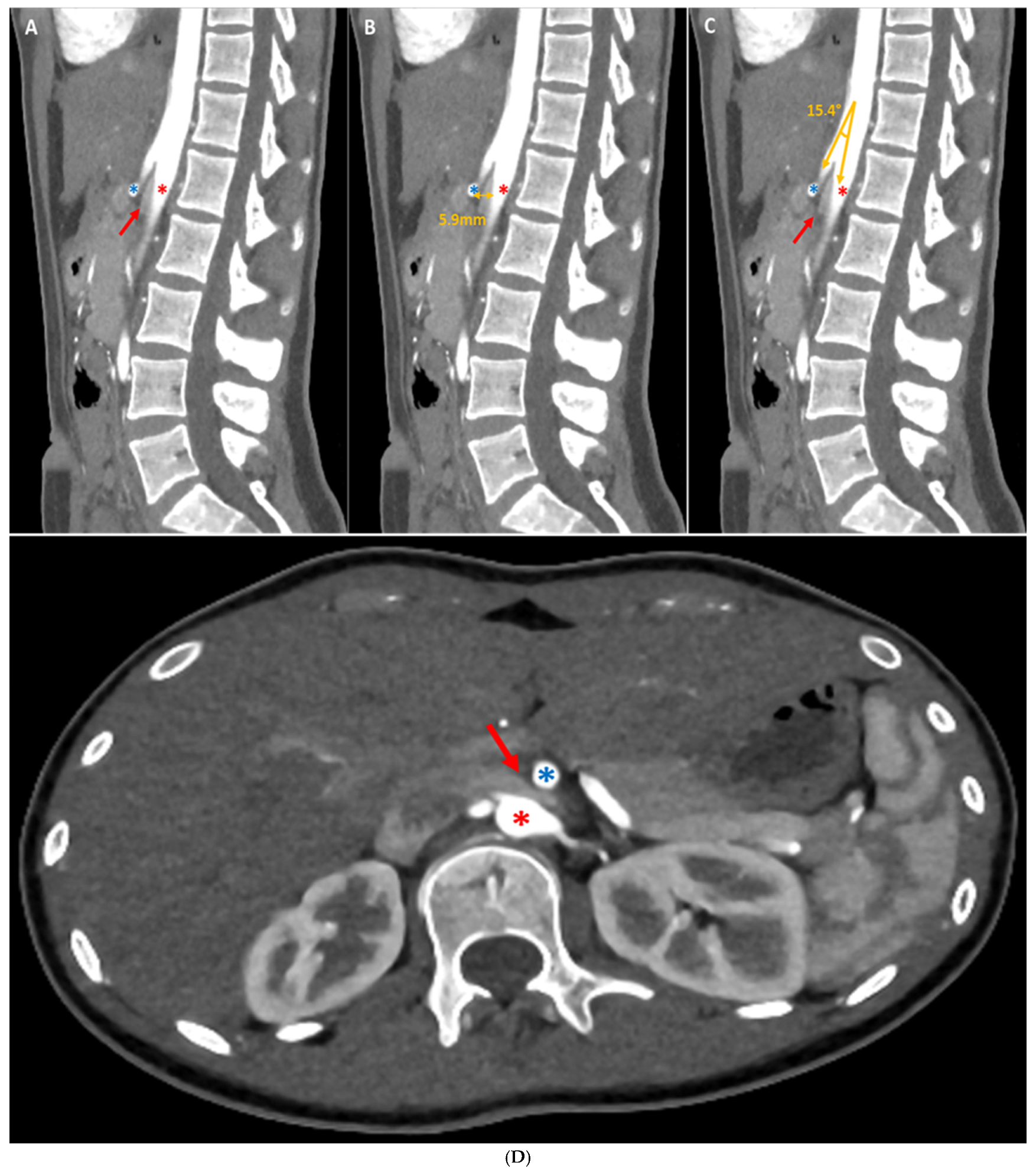 A Two-for-One Diagnosis: A Rare Case of Chronic Abdominal Pain Caused ...