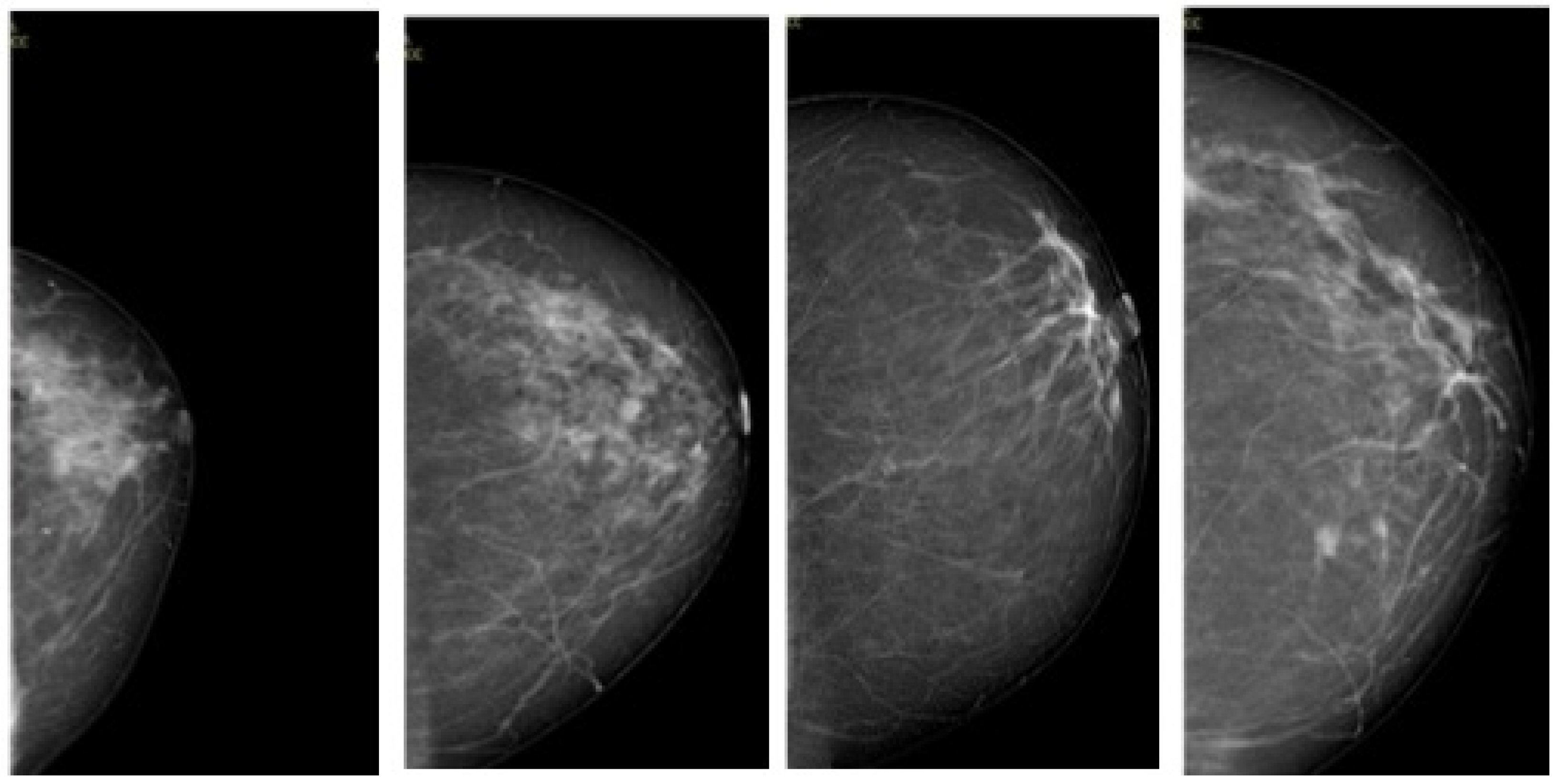 MammoViT: A Custom Vision Transformer Architecture for Accurate BIRADS ...