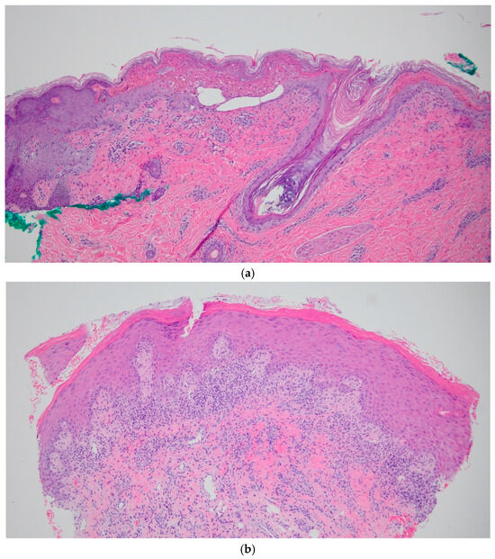 The Potential Roles of IL-1β, IL-6, and RIPK3 in the Pathogenesis of ...