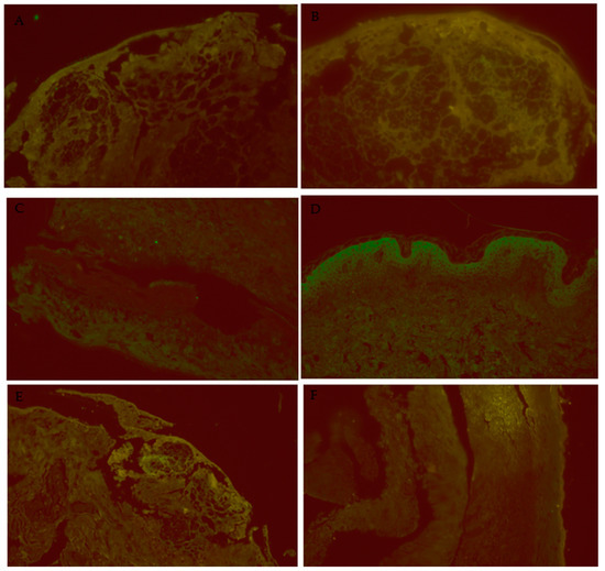 The Potential Roles of IL-1β, IL-6, and RIPK3 in the Pathogenesis of ...