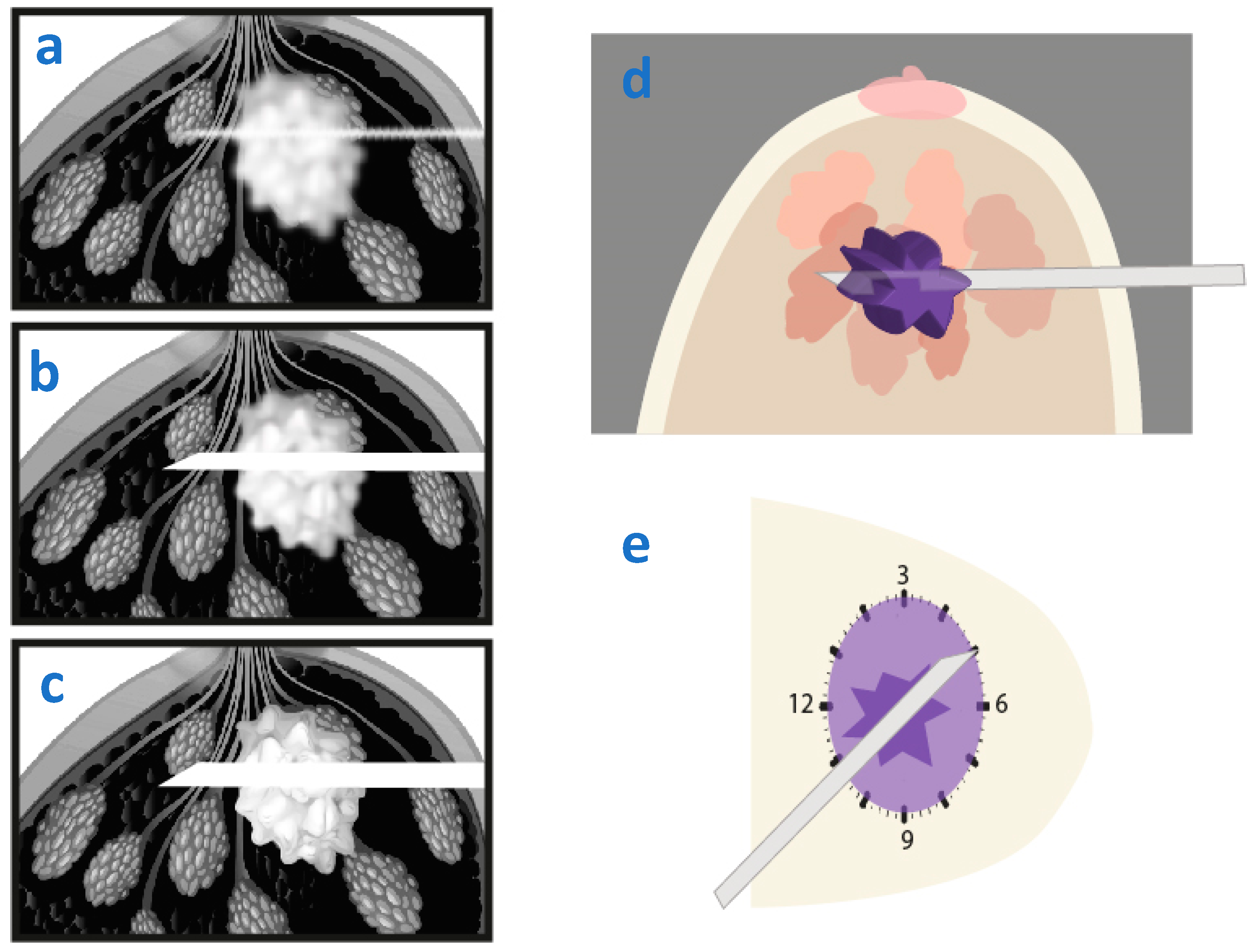 Tomosynthesis-Guided Biopsy: A Troubleshooting Guide