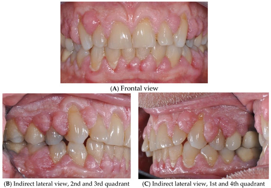 Calcium Antagonist-Induced Gingival Overgrowth: A Case Report and ...