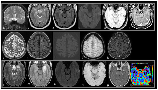 Multinodular and Vacuolating Neuronal Tumors: Imaging Features ...