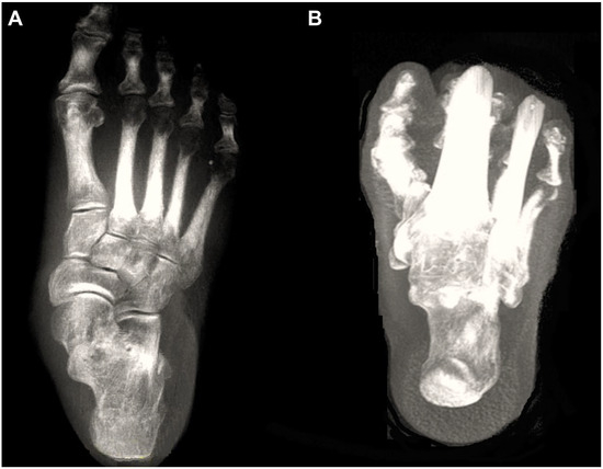 Weight-Bearing CT: Advancing the Diagnosis and Treatment of Hallux ...