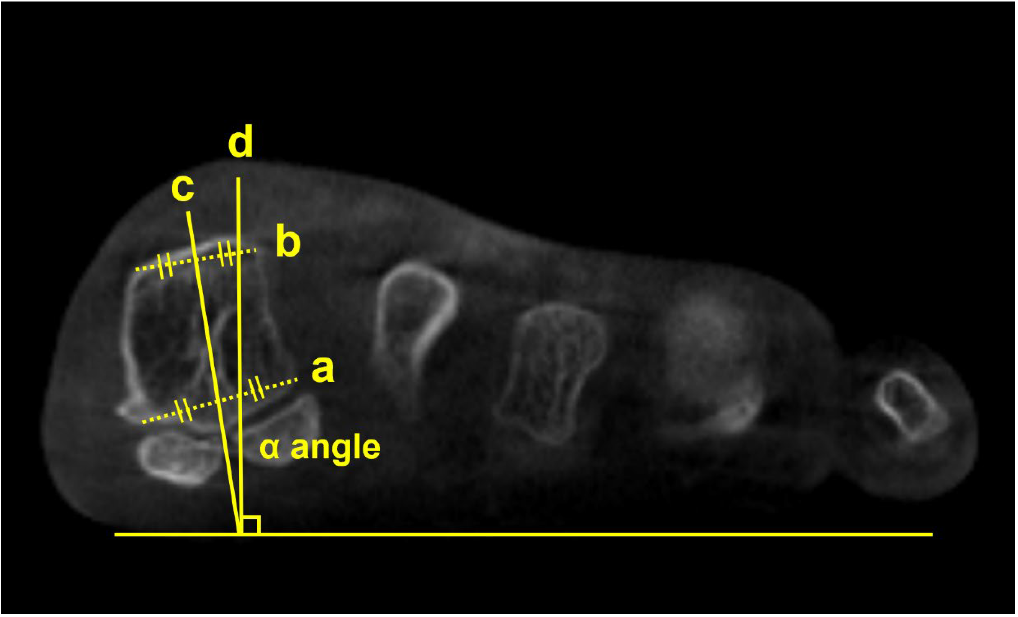 Weight-Bearing CT: Advancing the Diagnosis and Treatment of Hallux ...