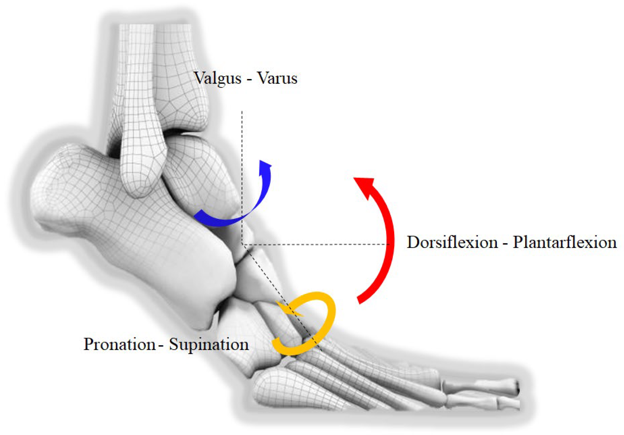 Weight-Bearing CT: Advancing the Diagnosis and Treatment of Hallux ...