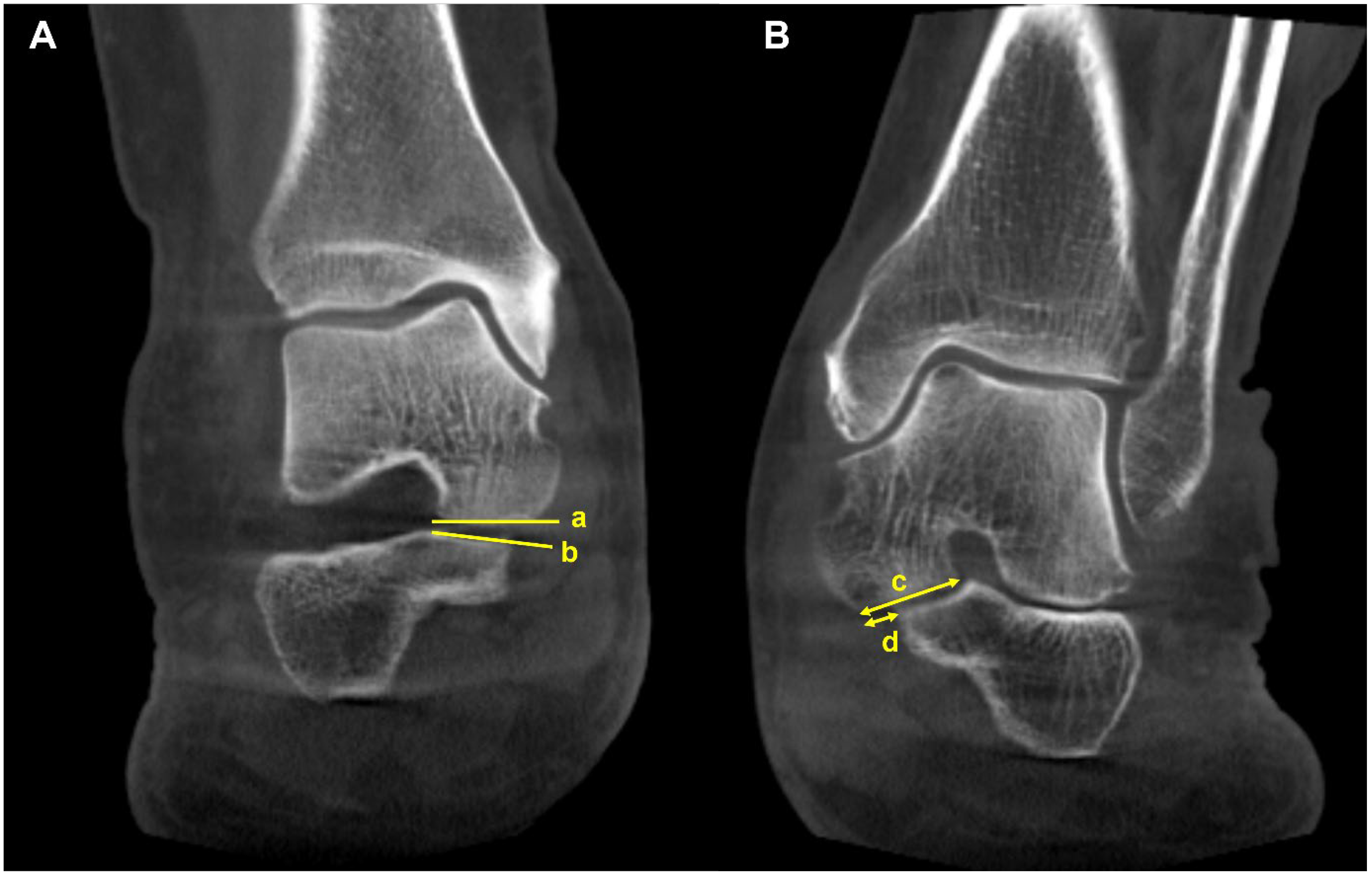 Weight-Bearing CT: Advancing the Diagnosis and Treatment of Hallux ...