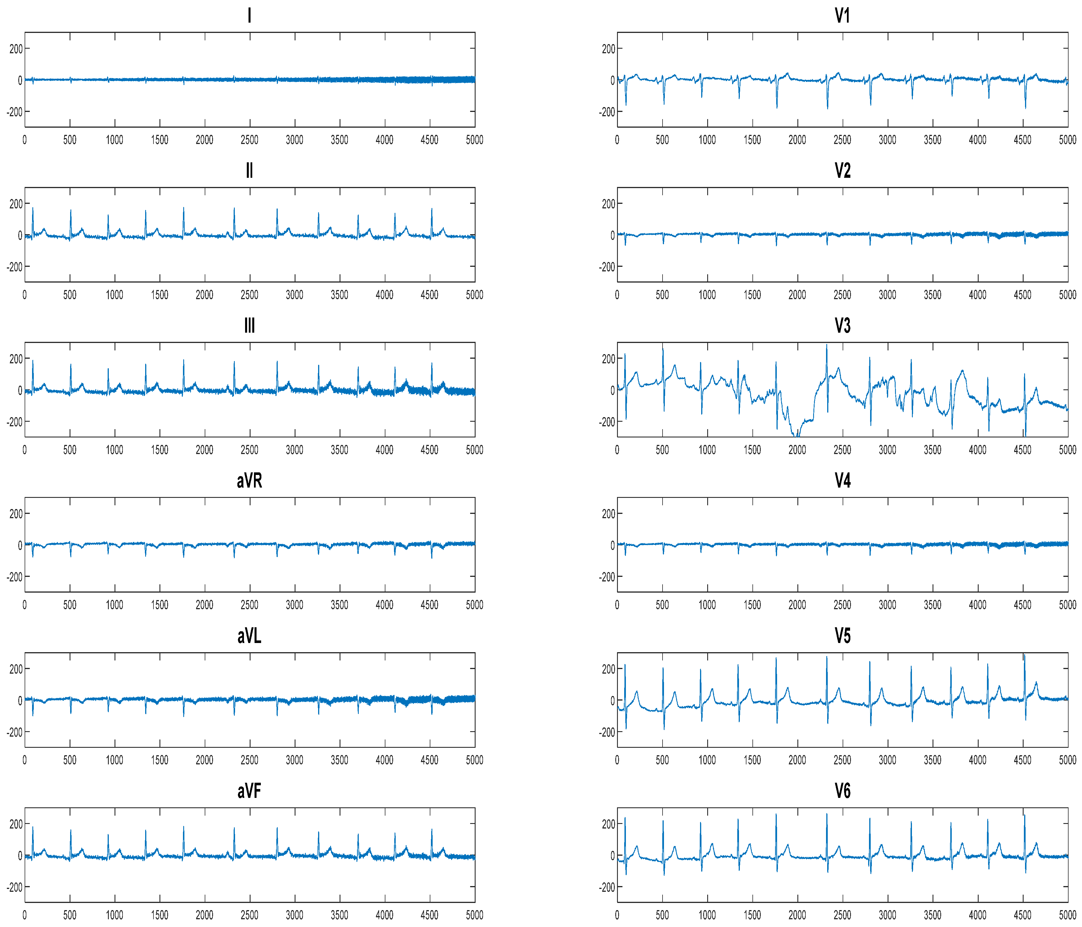Automatic Detection of Occluded Main Coronary Arteries of NSTEMI Patients with MI-MS ConvMixer ...